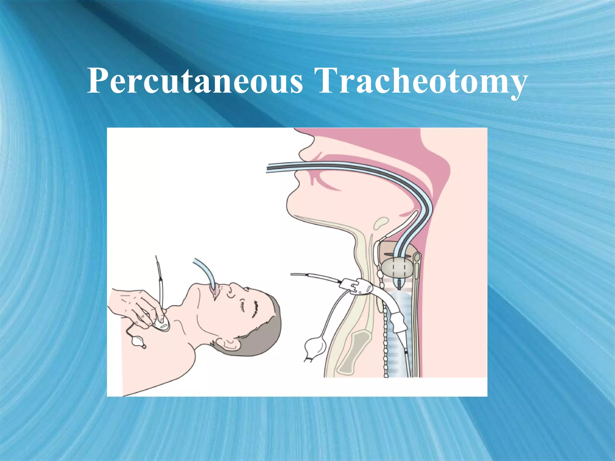 Tracheotomy - UCLA Head and Neck Surgery, ENT Ear, Nose & Throat ...