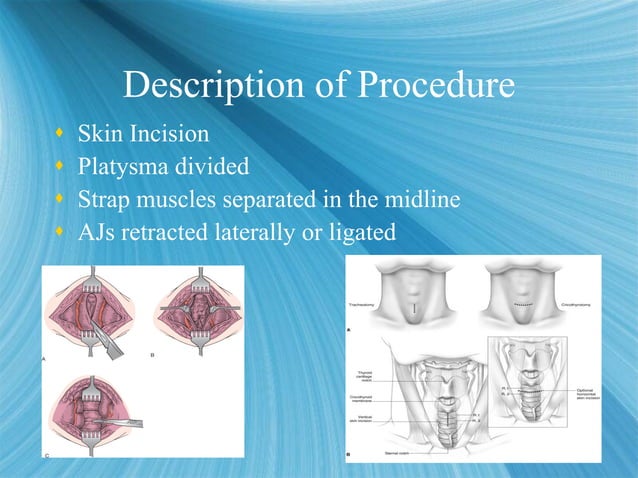 Tracheotomy - UCLA Head and Neck Surgery, ENT Ear, Nose & Throat ...