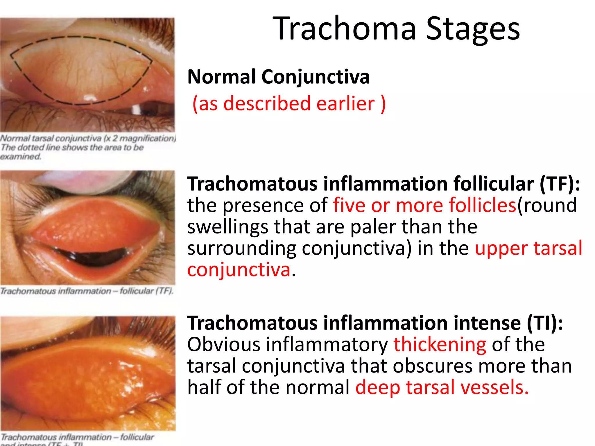 Trachoma | PPTX