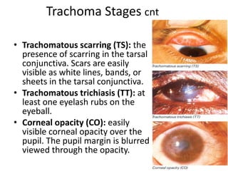 Trachoma | PPTX