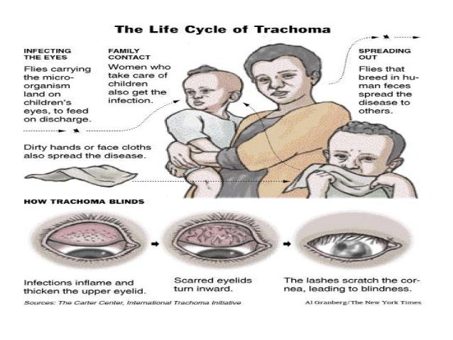 Trachoma
