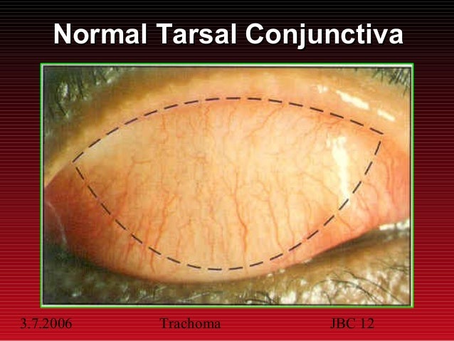 Trachoma