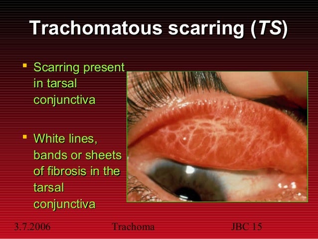 Trachoma
