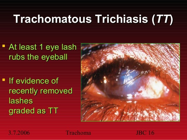 Trachoma