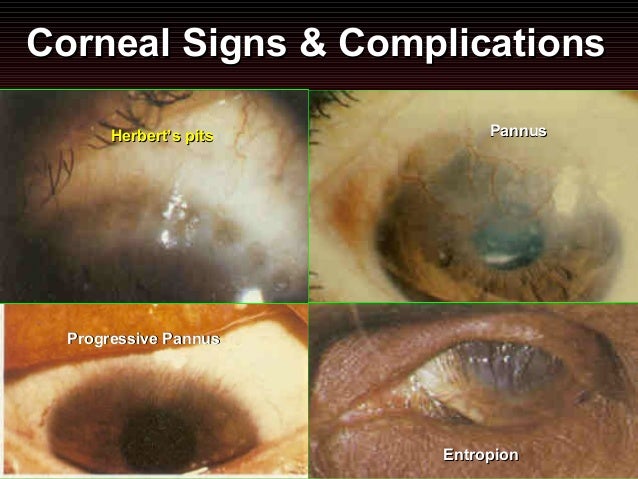 Trachoma