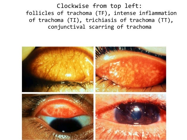 Trachoma