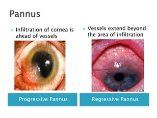 Trachoma | PPT