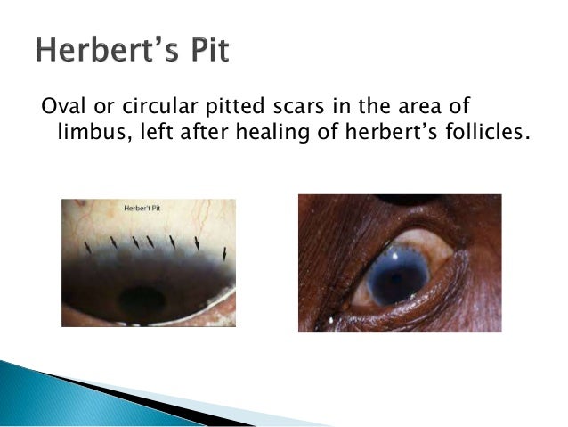 Herberts Pits