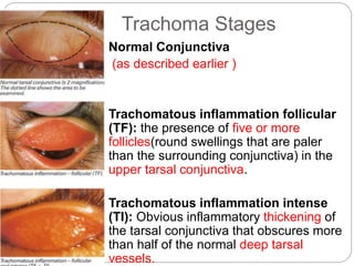 Trachoma Stages
