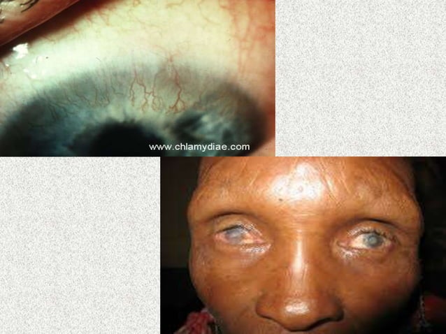 Trachoma | PPTX | Eye and Vision Conditions | Diseases and Conditions