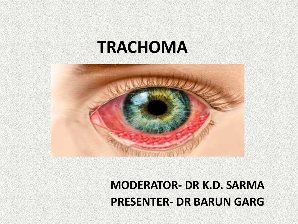 Trachoma