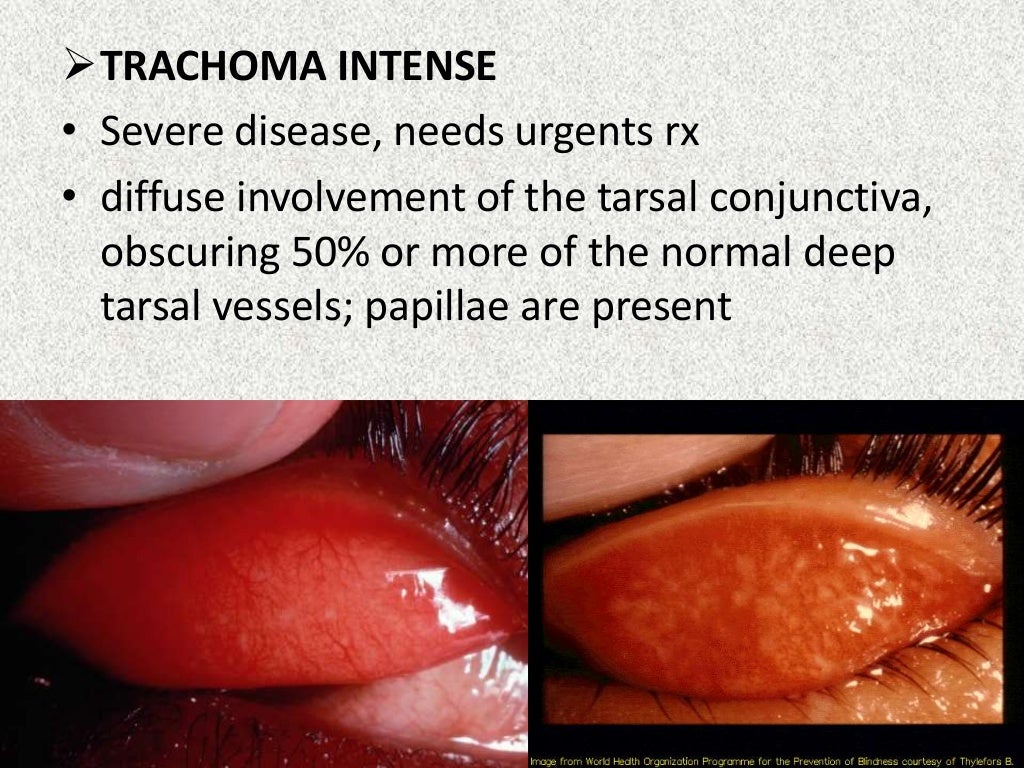 Trachoma