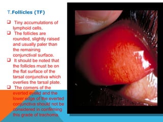 Trachoma | PPT