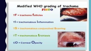 Trachoma Stages