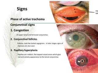 Trachoma | PPTX