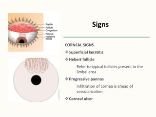 Trachoma | PPTX