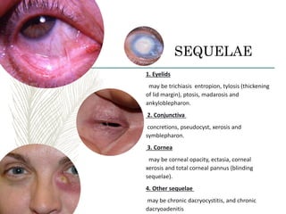 Trachoma | PPTX
