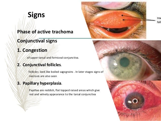 Trachoma