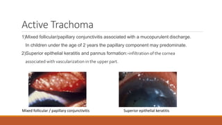 Trachoma | PPT