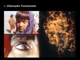 TRACHOMA.ppt