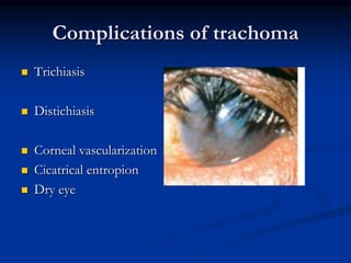 Trachoma.pptx