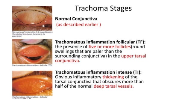 Trachoma of human eye for certificate nurses | PPTX | Eye and Vision ...