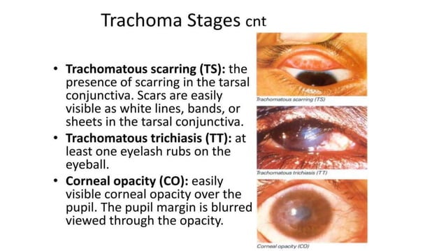 Trachoma of human eye for certificate nurses | PPTX | Eye and Vision ...