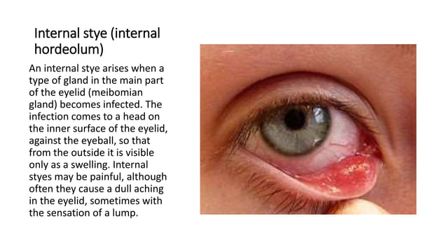 Trachoma of human eye for certificate nurses | PPTX | Eye and Vision ...