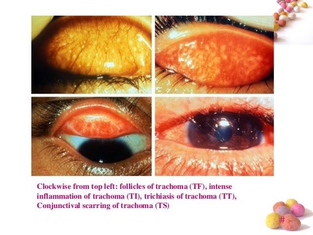 Trachoma By Sumayya Naseem
