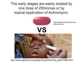 Trachomafinal.ppt | Eye and Vision Conditions | Diseases and Conditions