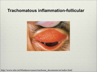 Trachomafinal.ppt | Eye and Vision Conditions | Diseases and Conditions