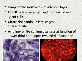 trachoma ophthalmology powerpoint presentation.pptx | Eye and Vision ...