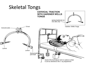 Cervical Skeletal Traction