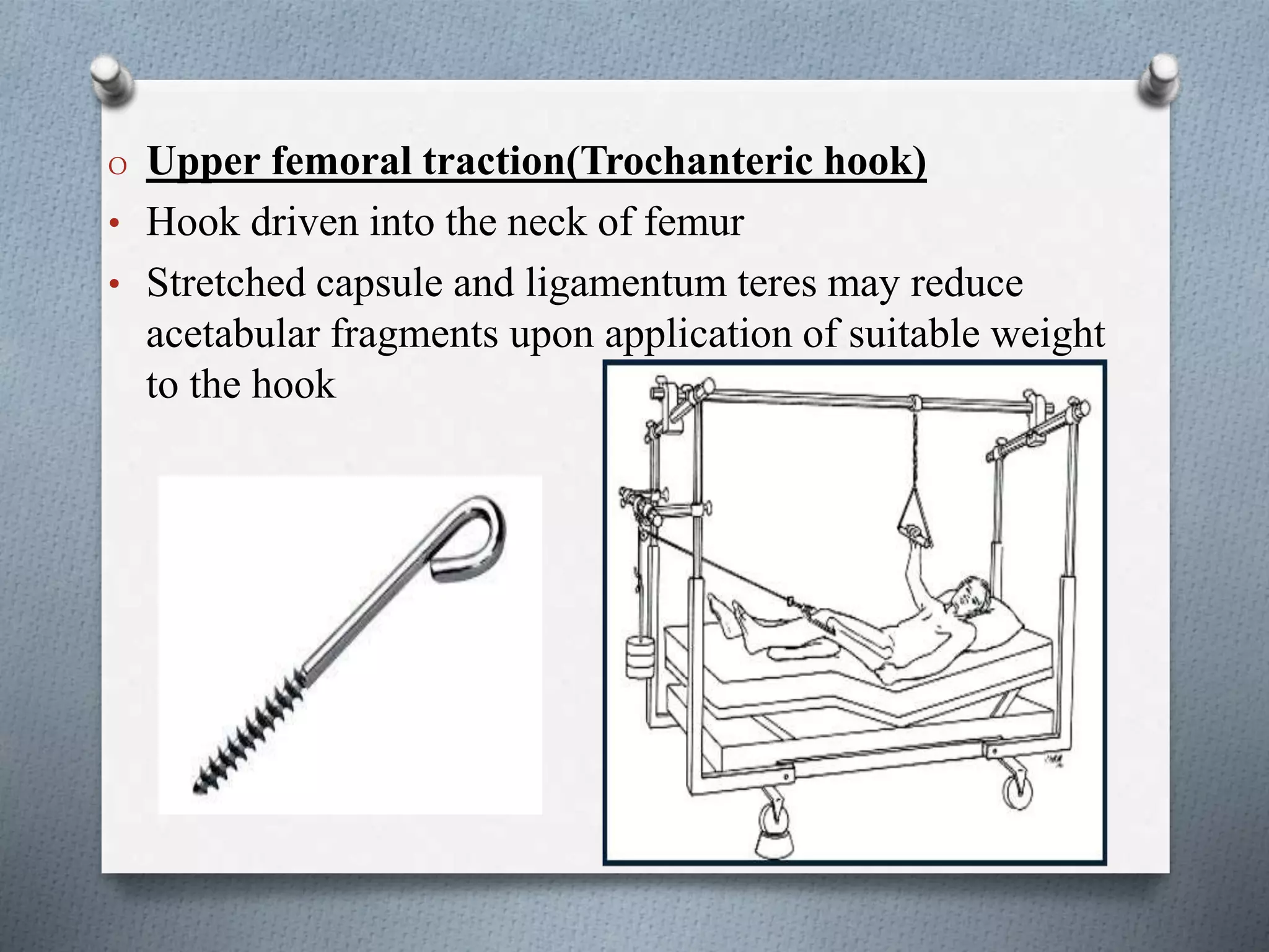 Traction in orthopaedics | PPTX