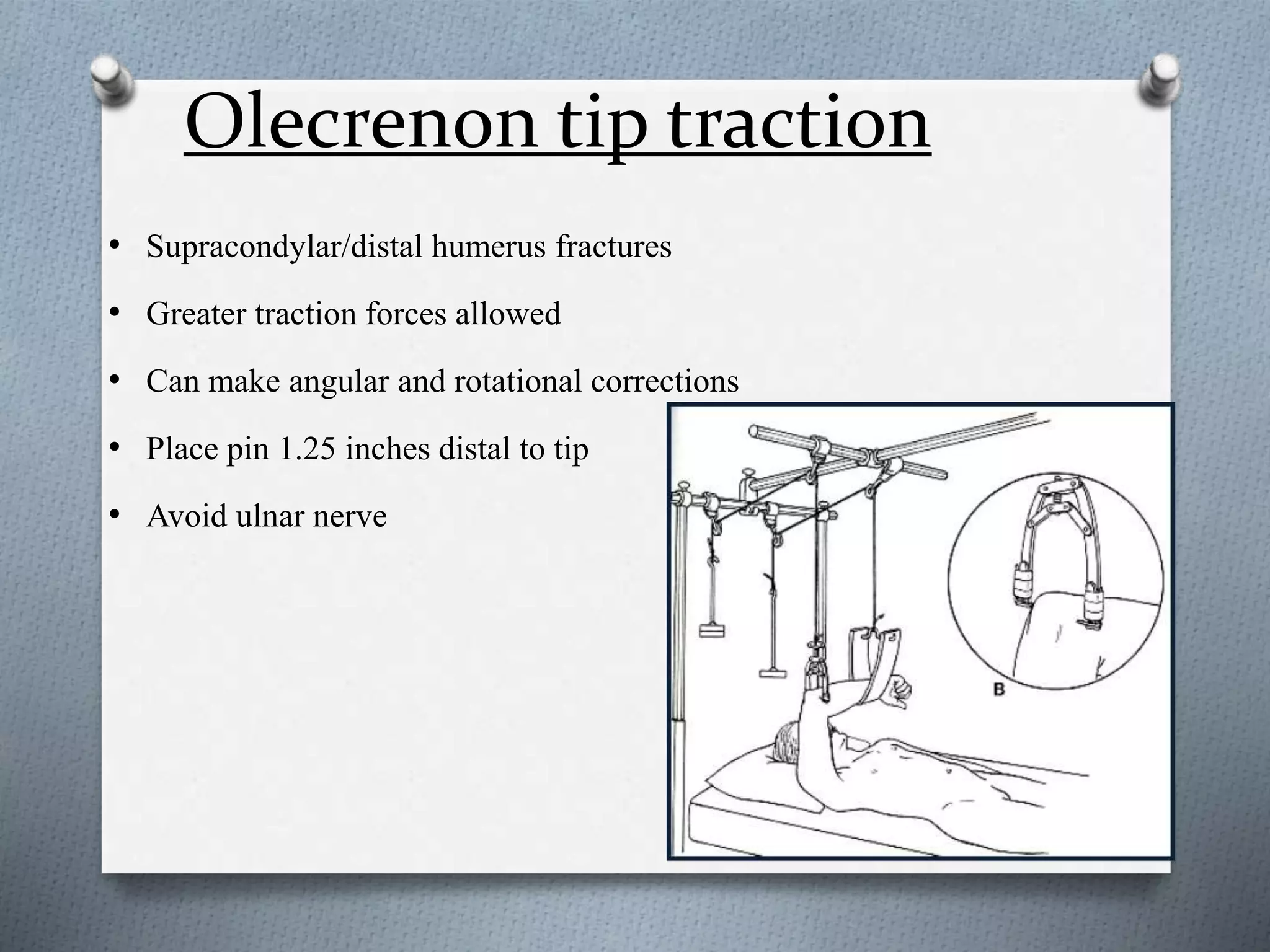 Traction in orthopaedics | PPTX