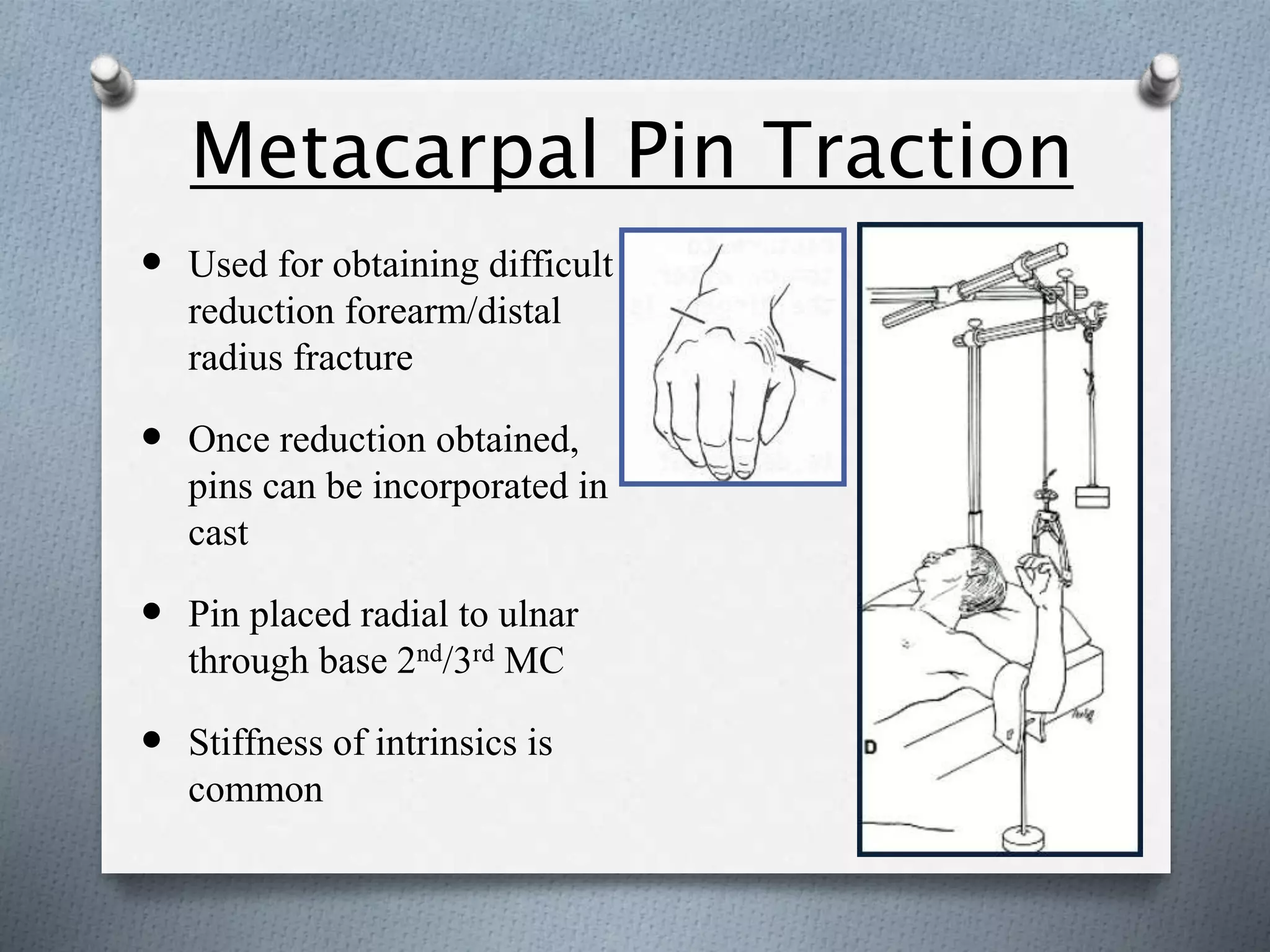Traction in orthopaedics | PPTX