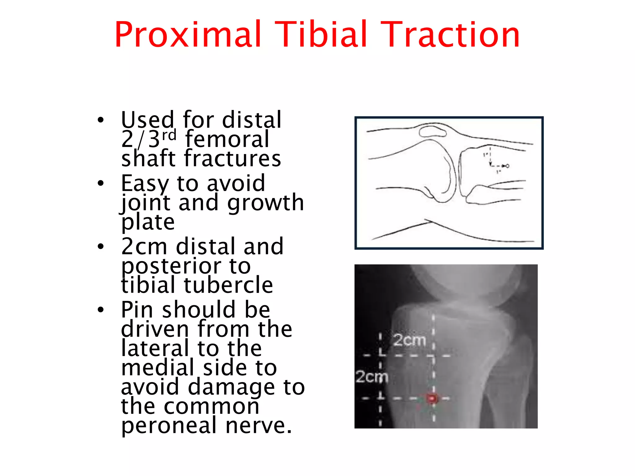 Traction in Orthopaedic | PPTX