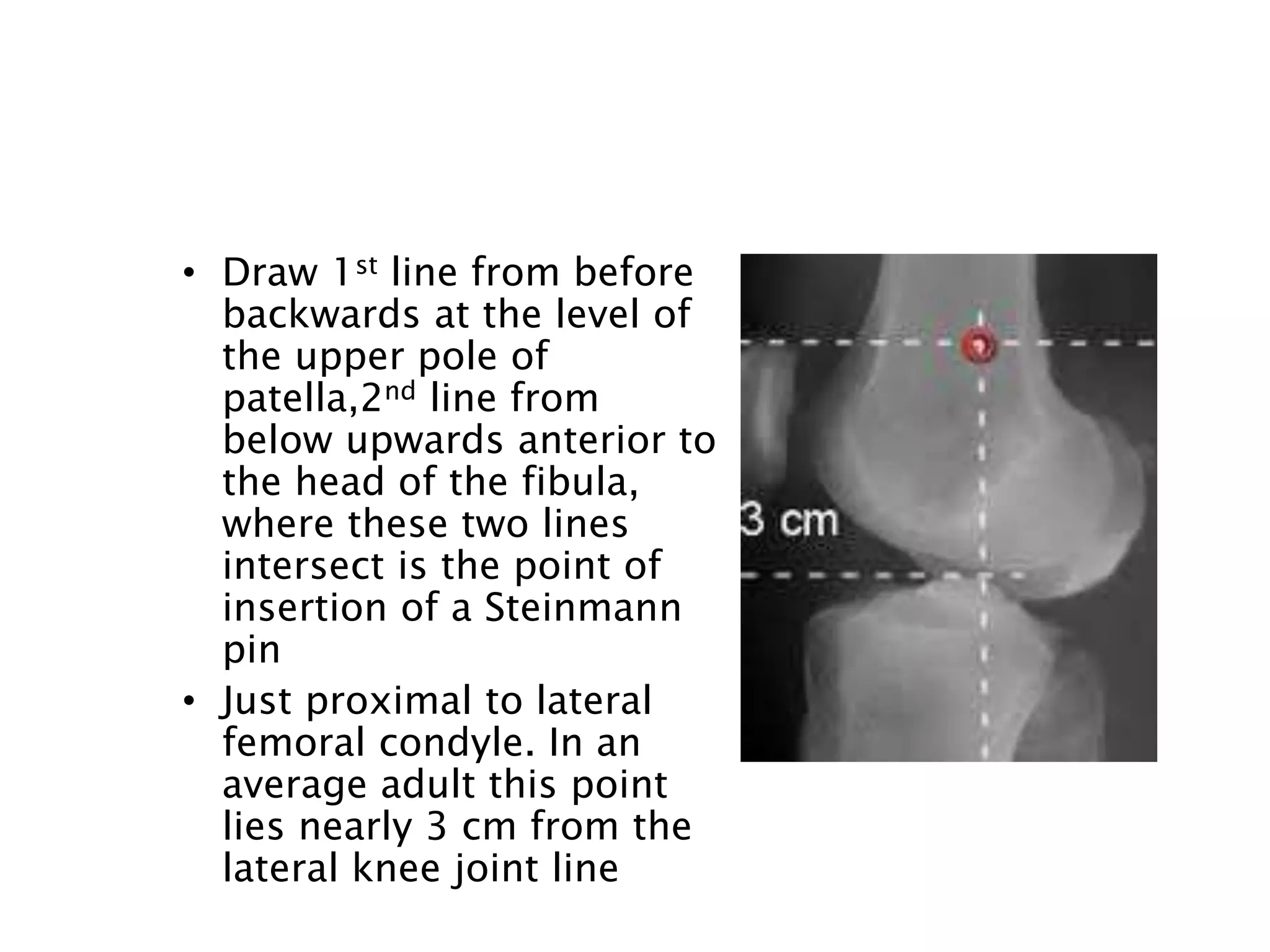 Traction in Orthopaedic | PPTX