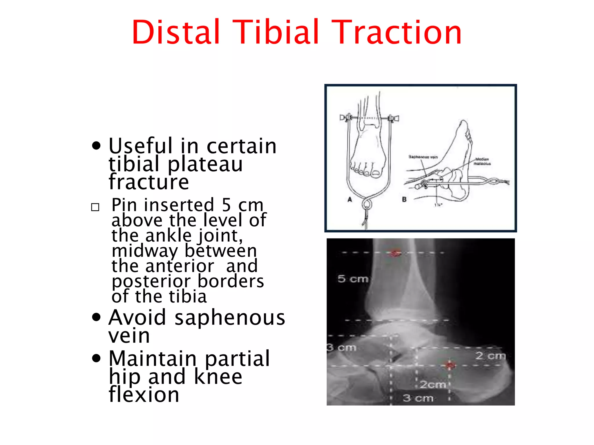 Traction in Orthopaedic | PPTX