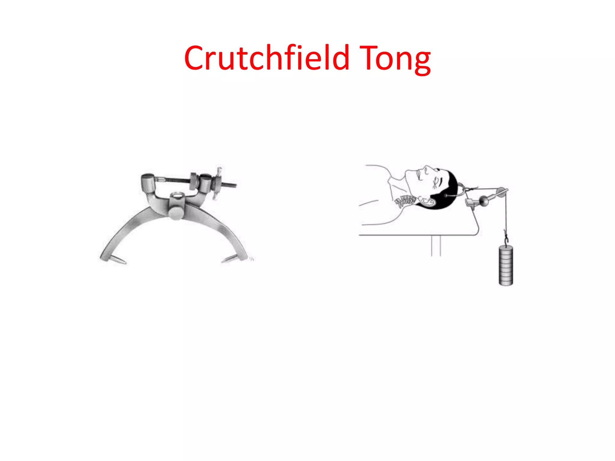 Traction in Orthopaedic | PPT