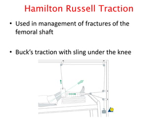 Traction in Orthopaedic | PPT