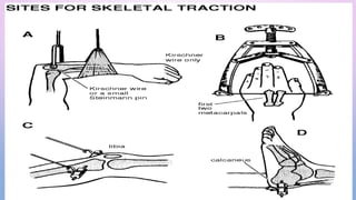 Traction | PPTX | Death, Injury, or Military Conflict | Sensitive Topics