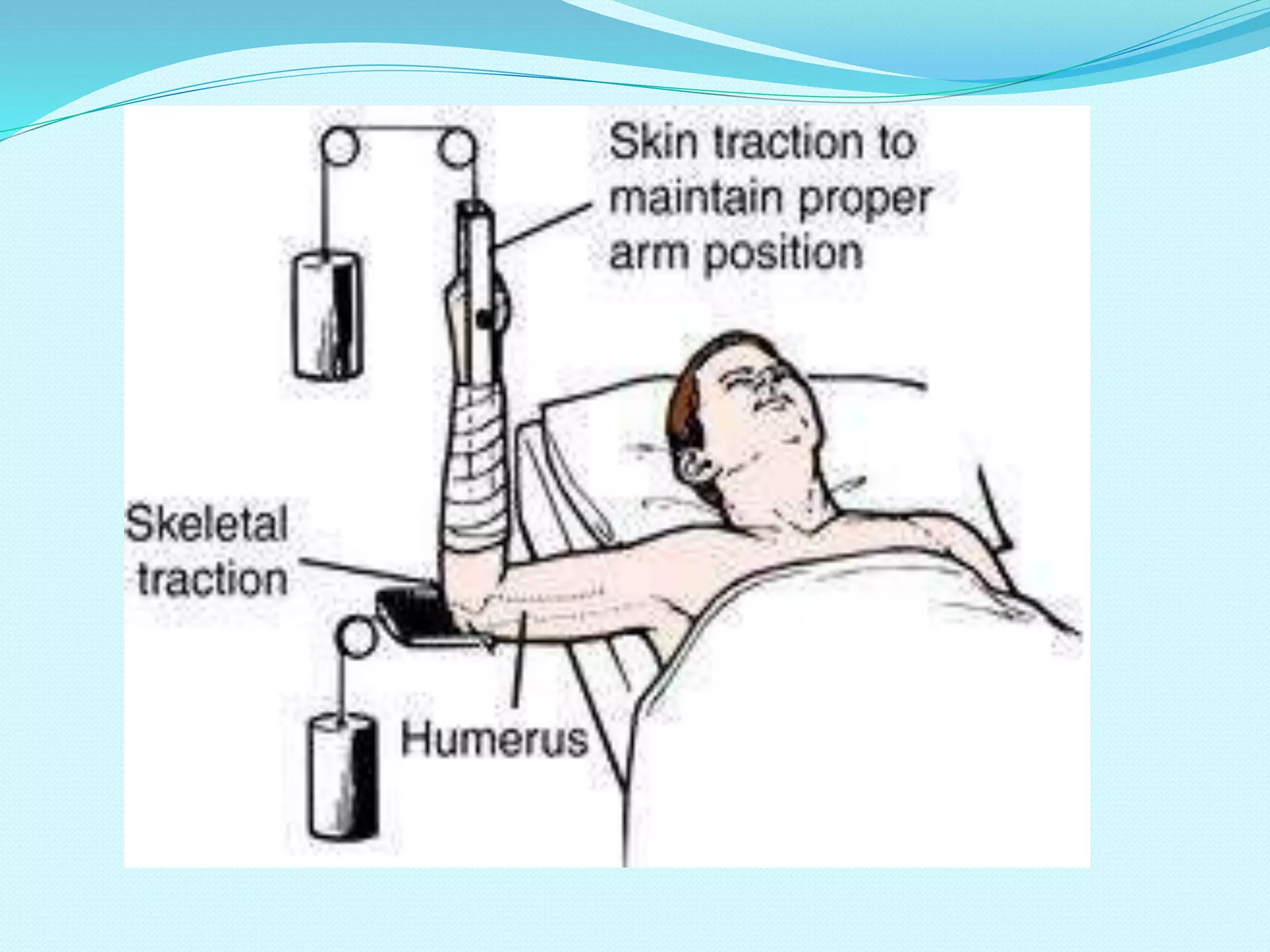TRACTION for nursing students | PPTX
