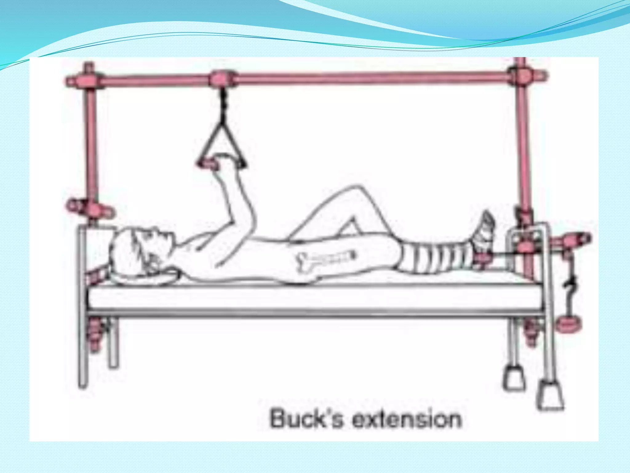 TRACTION for nursing students | PPTX