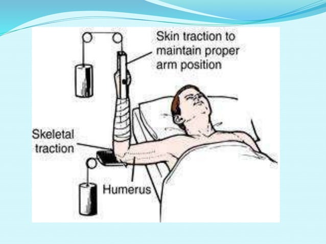 TRACTION for nursing students | PPTX | First Aid | Injuries