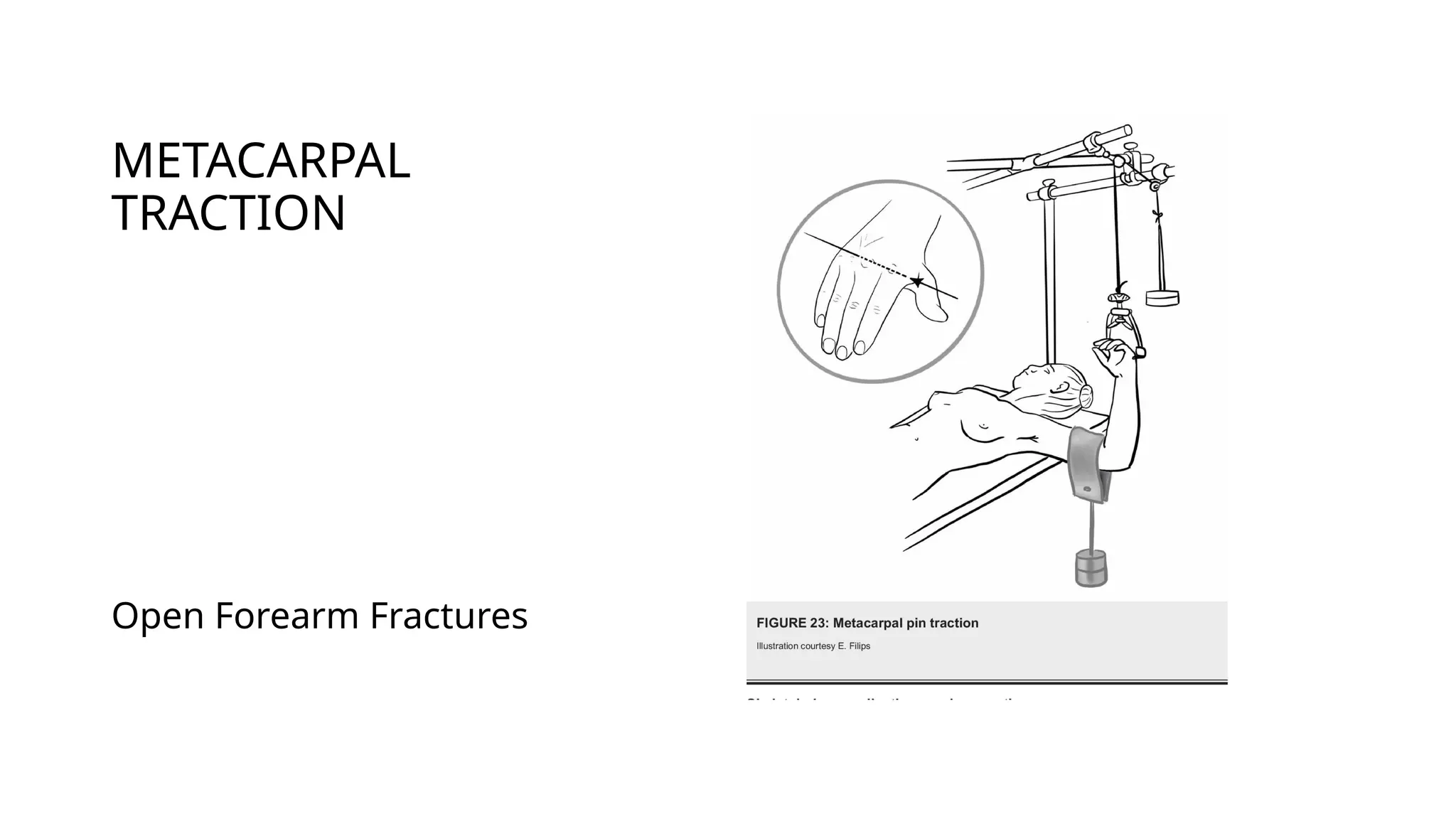 Traction used in orthopedics and practice | PPTX