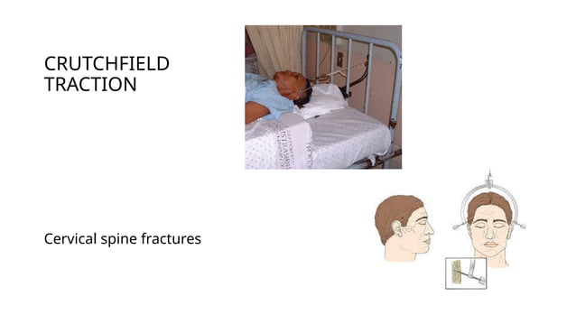 Traction used in orthopedics and practice | PPT