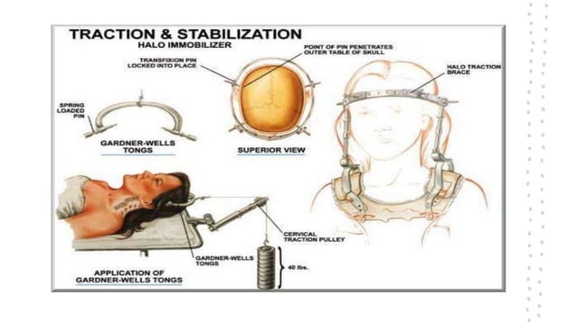 TRACTION.pptx orthopedics lecture series | PPT