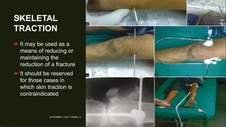 Traction In Orthopedics | PPTX