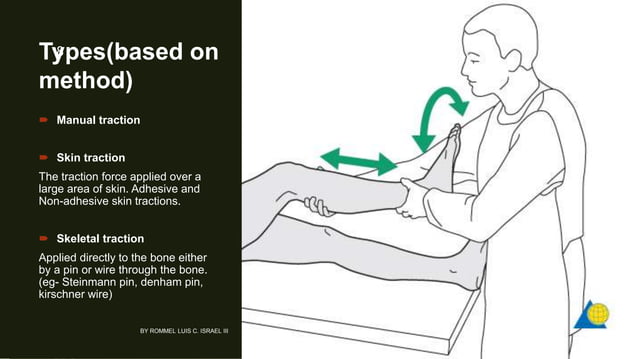 Traction In Orthopedics | PPTX
